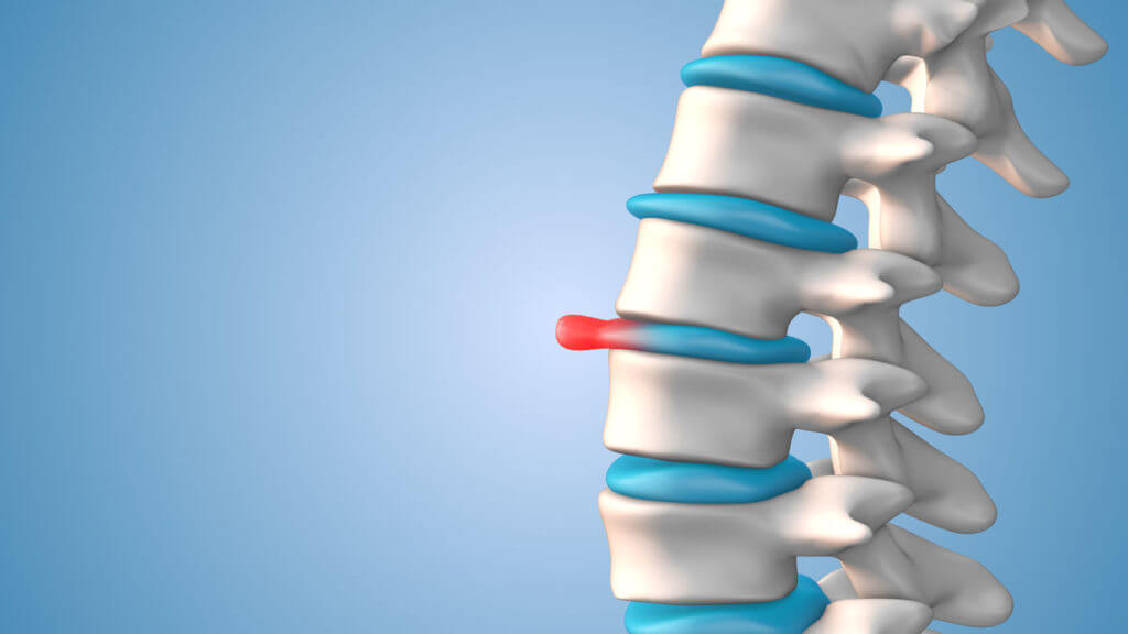 Herniated Discs: Symptoms, Diagnosis, and Treatment Options