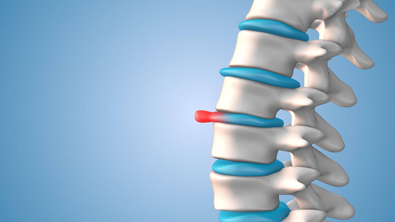 Herniated Disc symptoms Archives - Advanced Orthopedics New England